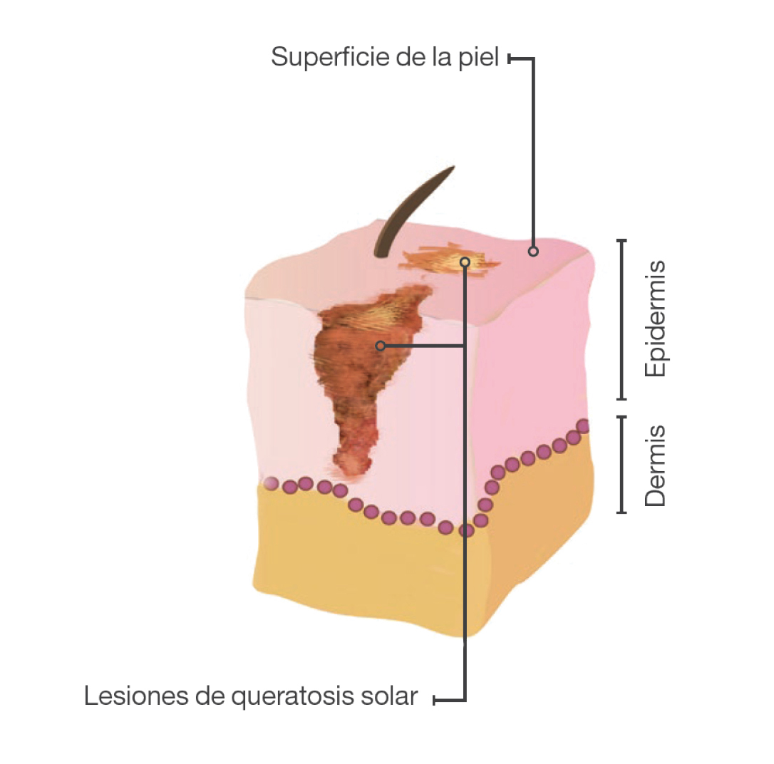 Todo sobre... la queratosis actínica - Dermatología