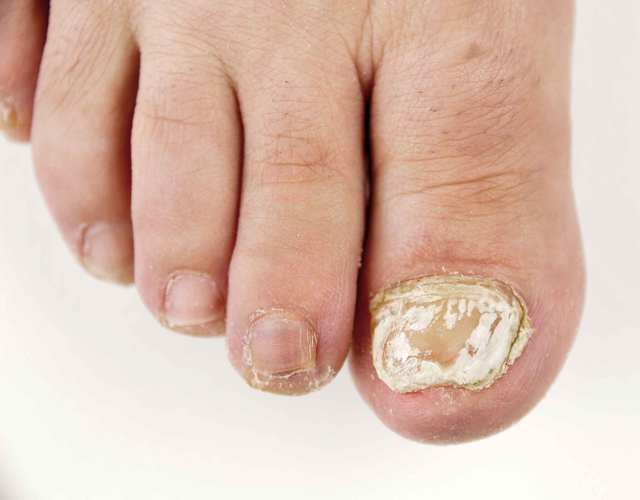 Enfermedades de las uñas - Dermatología