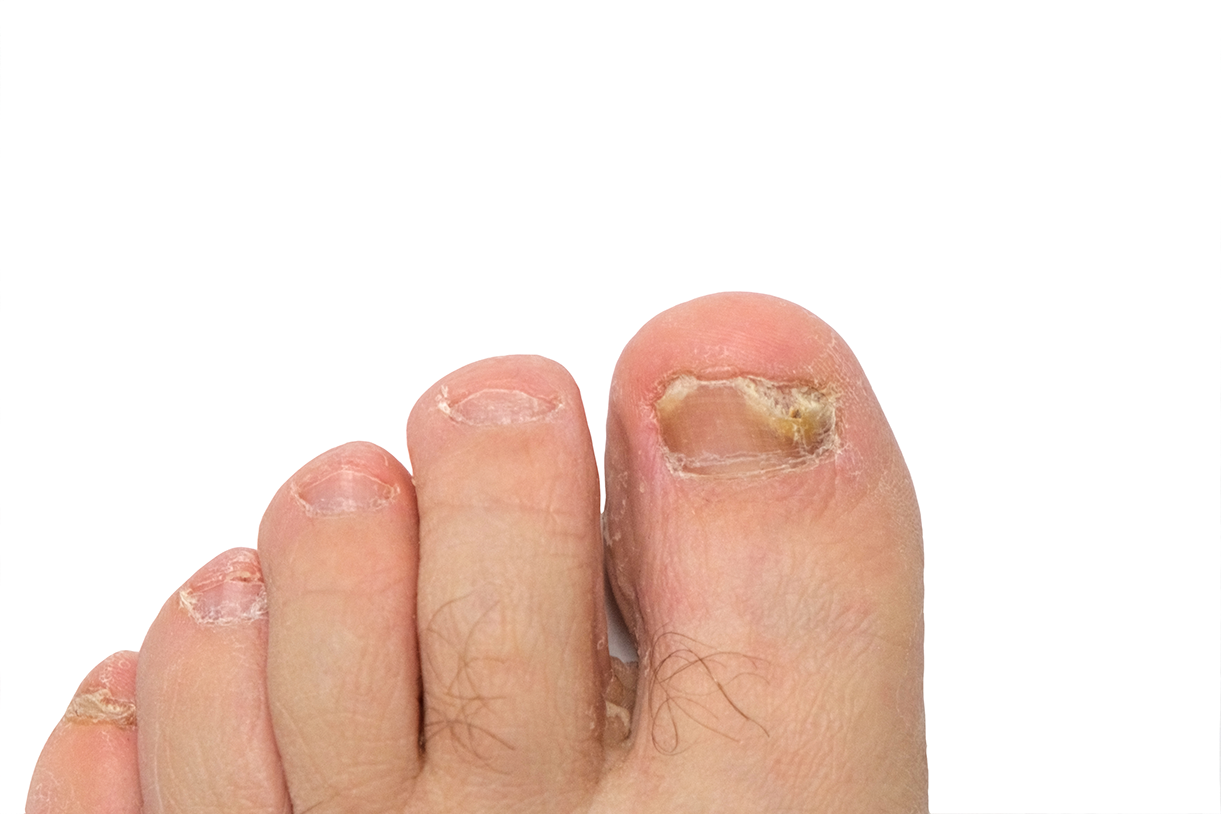 Todo sobre... la onicomicosis - Dermatología