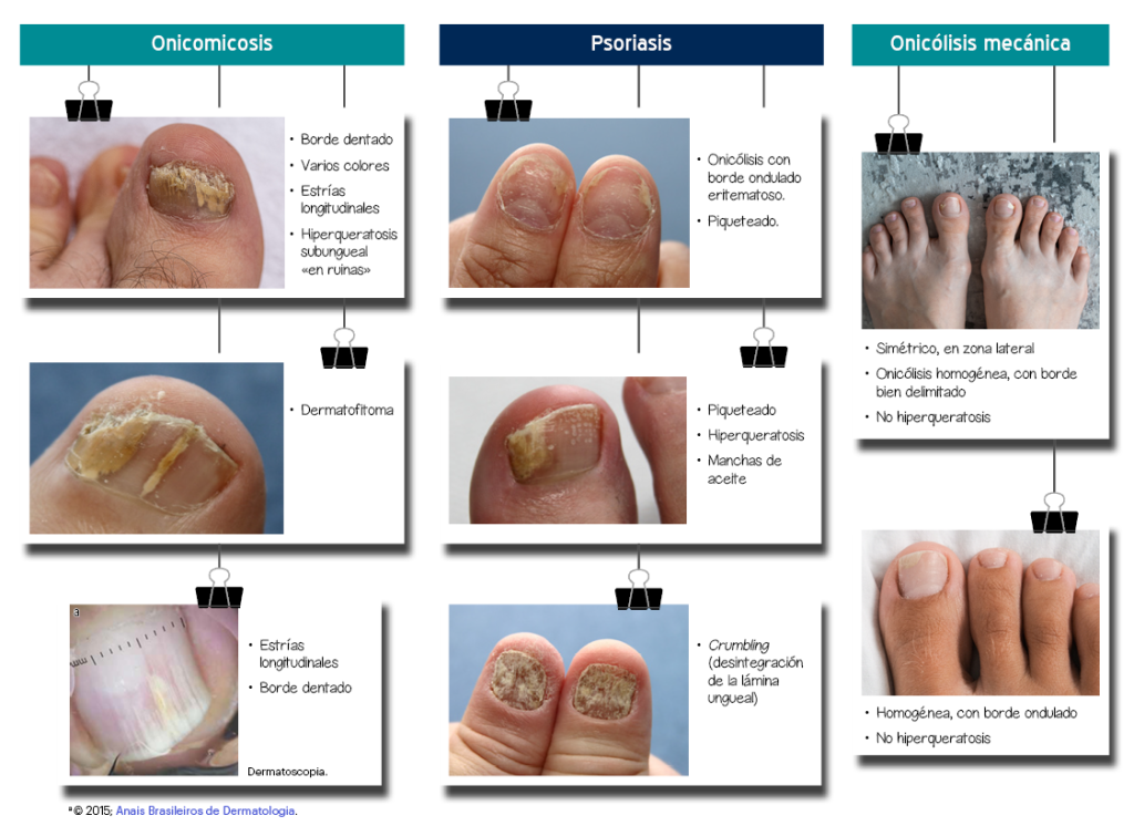 Todo sobre... la onicomicosis - Dermatología
